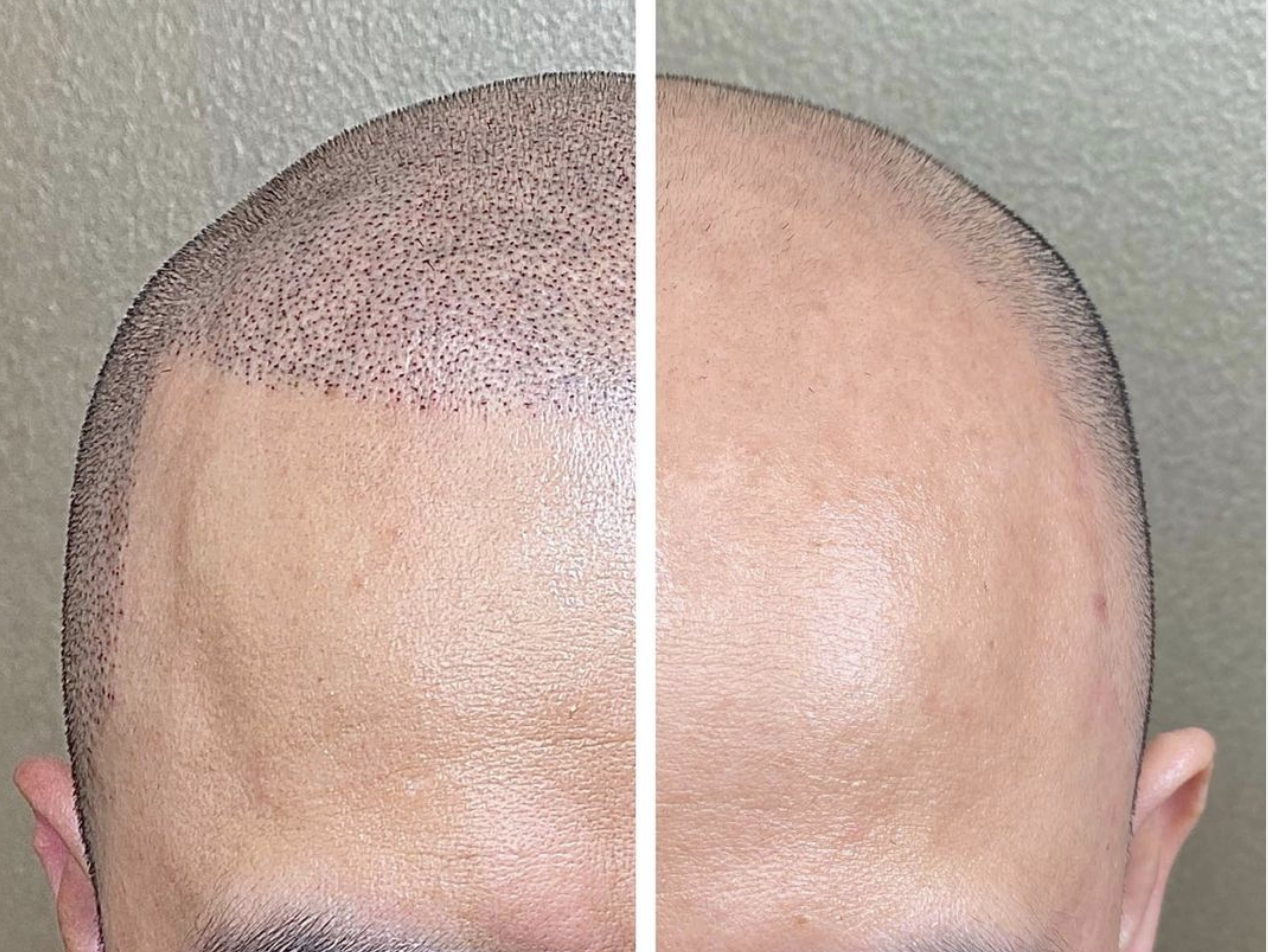 Staten Island's Top Scalp Micropigmentation Services
